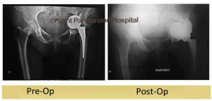 Revision Total Hip Replacement | Dr. Shekhar Agarwal