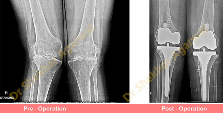 Primary Complex Total Knee Replacement ( Valgus Knee ) | Dr. Shekhar ...